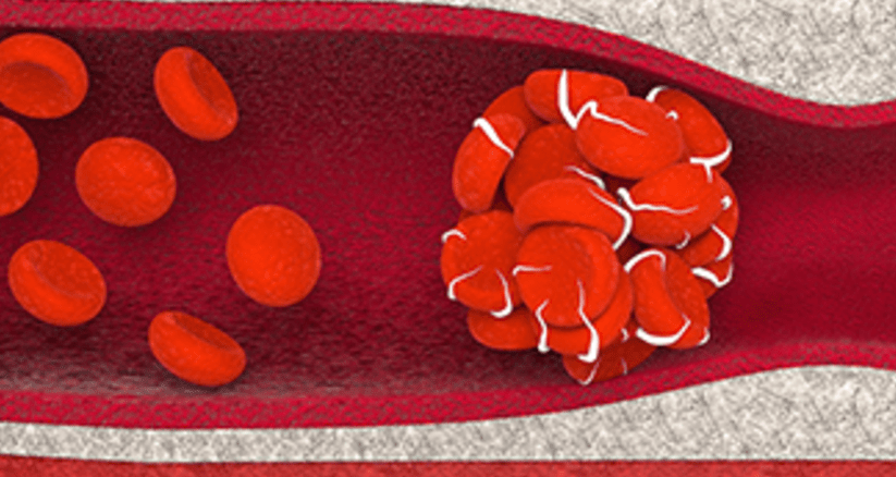 B3 Bands for Blood Clots - B3 Sciences